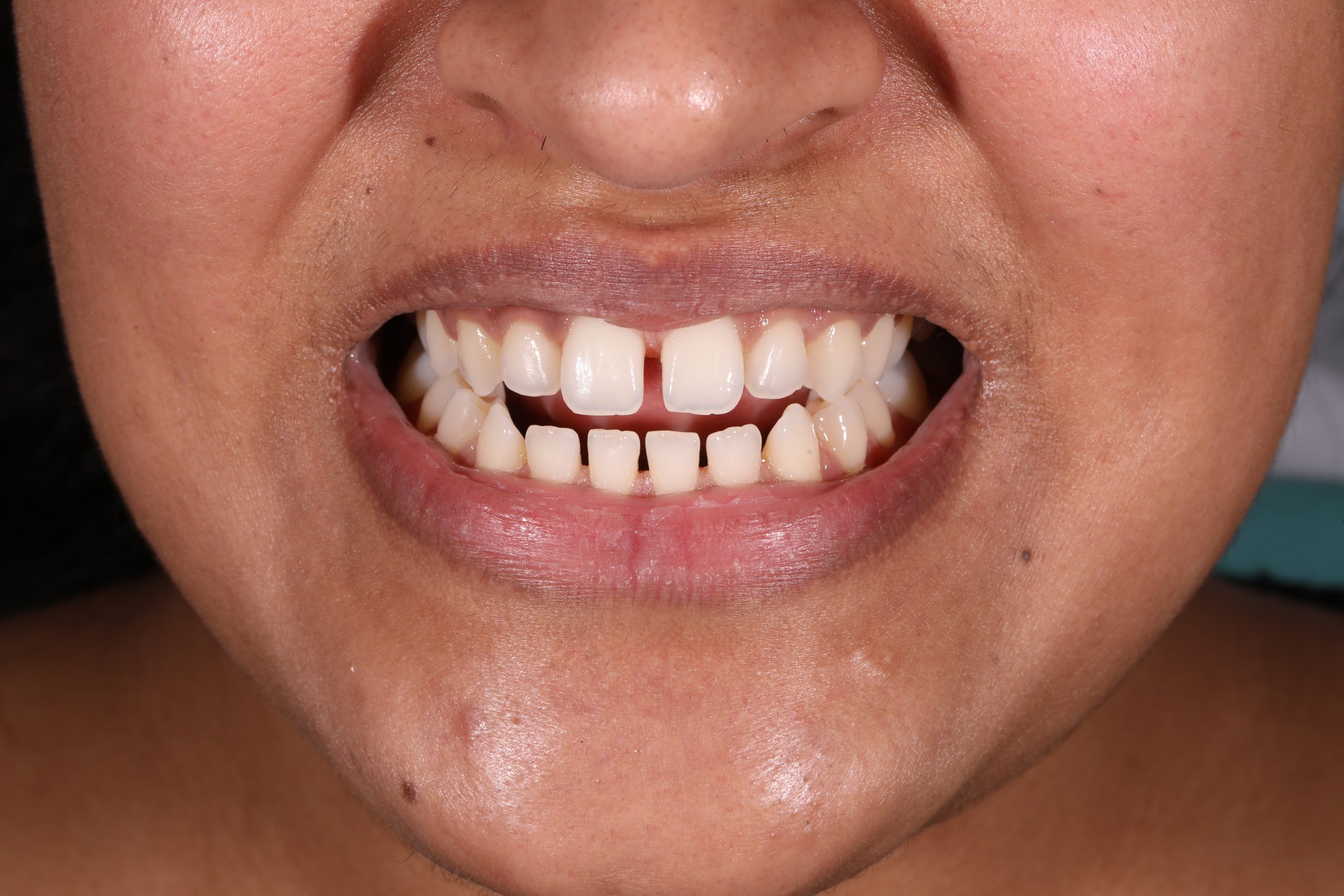 Closing an open bite and gapped teeth with Invisalign - Maison Dental