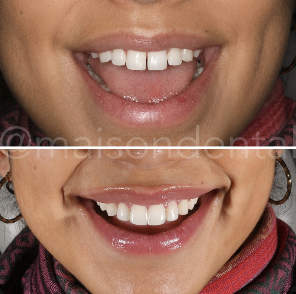 Closing the Middle Gap and Creating a Beautiful Natural Result - Maison ...