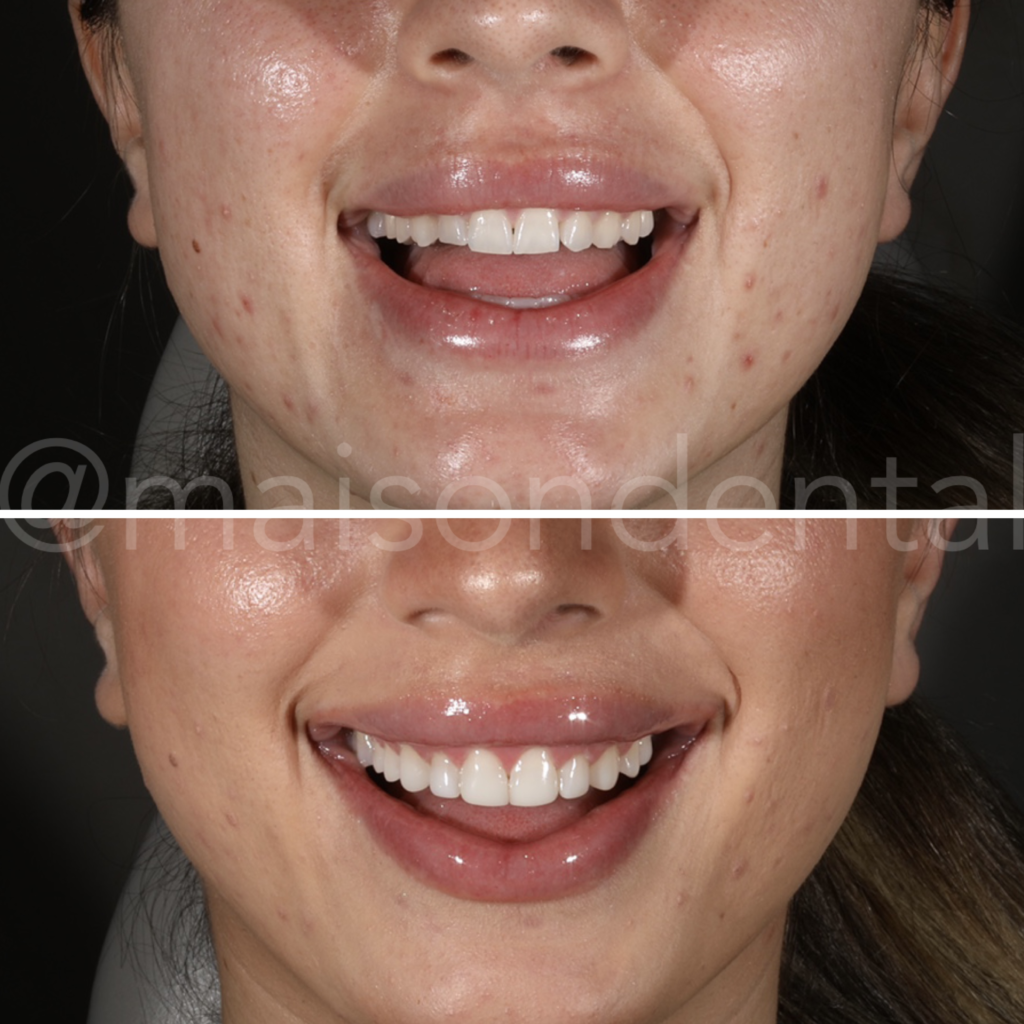 10 Direct Composite Veneers to Repair the Broken Edges - Maison Dental