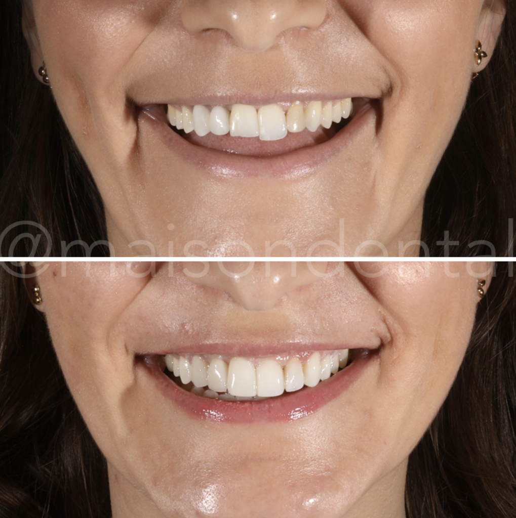 Composite Veneers & a New Dental Bridge - Maison Dental